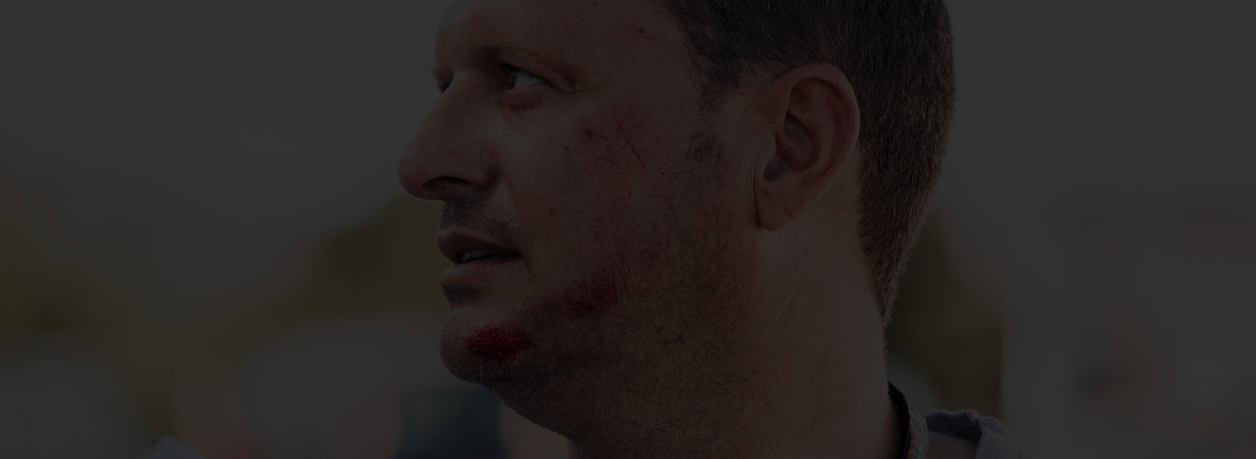 Disfigurement Injury Lawsuits – The Ammons Law Firm